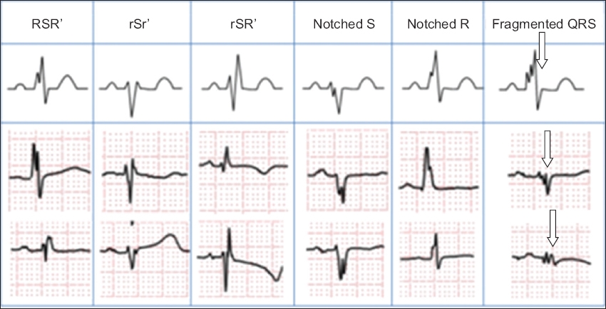 Masking Of Myocardial Infarction ECG In A Patient With Wolff Parkinson Masking Of Myocardial Infarction ECG In A Patient With Wolff Parkinson
